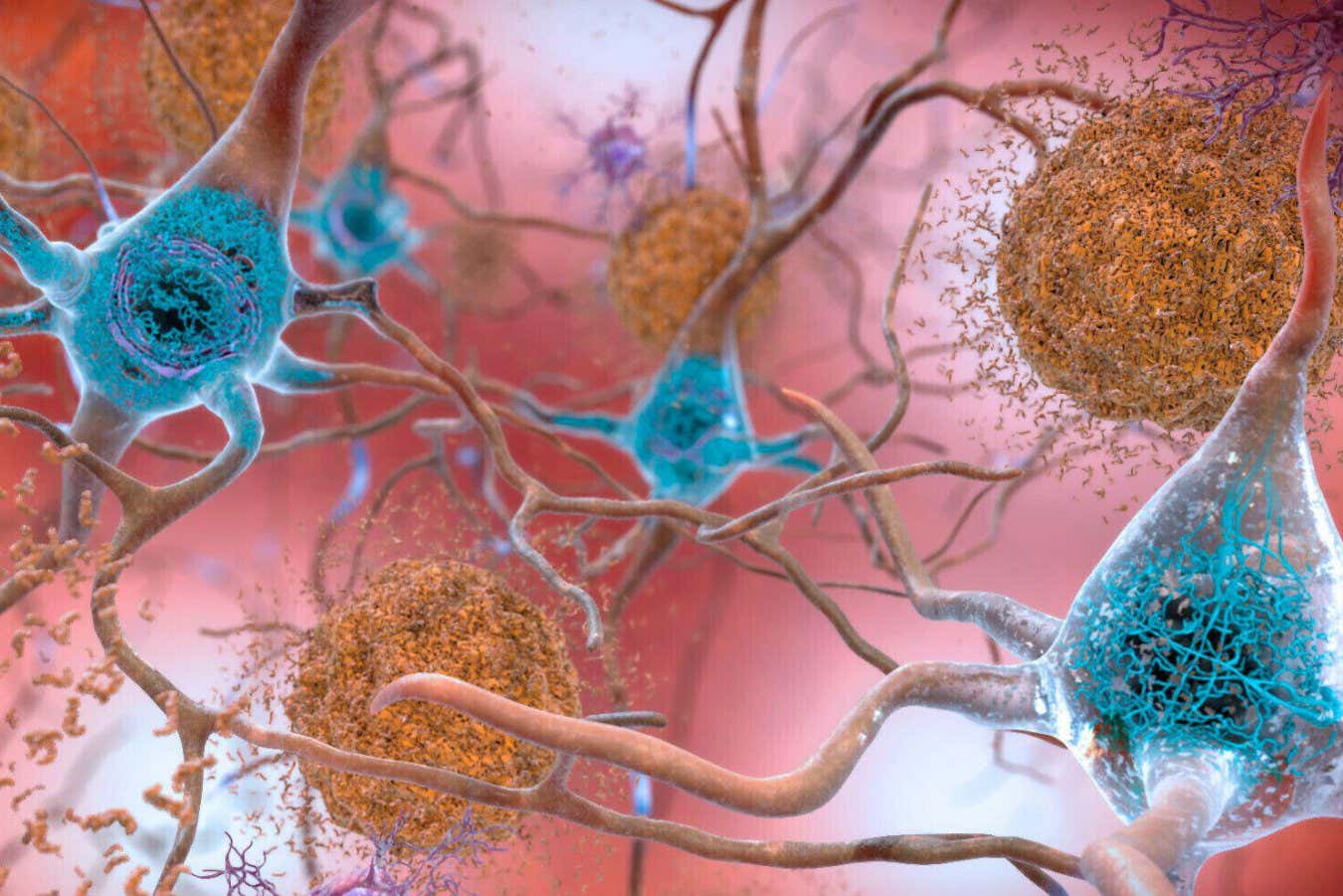 Why people can have Alzheimer's-related brain damage but no symptoms ...